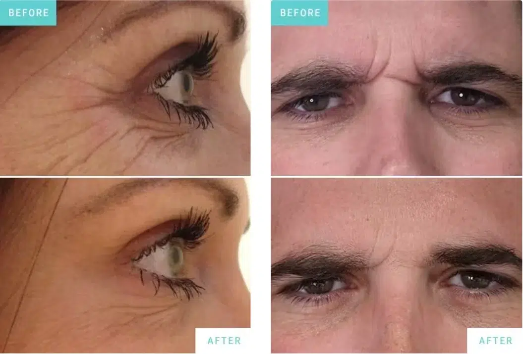 Zonele care pot fi tratate cu acid hialuronic - Skina Dermatologie ...